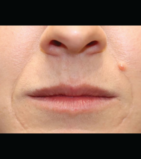 Before & After Gallery | Facial Plastic Surgery Results