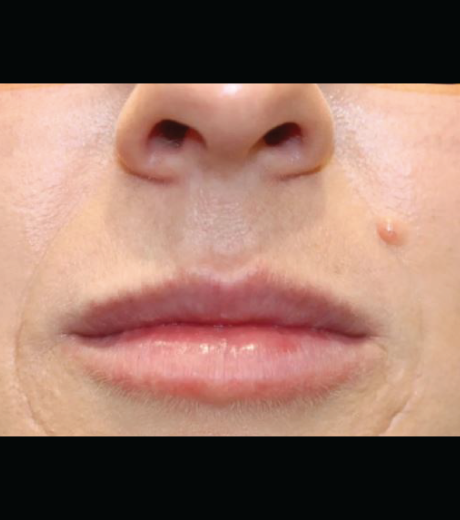 Before & After Gallery | Facial Plastic Surgery Results